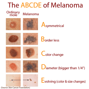 Nevi - Dermatoscopie computerizată | Δρ. Υφαντή